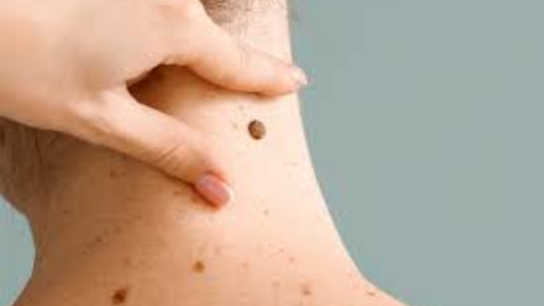 Skin Tags: Causes, Treatments, and Prevention - Dr. Praneeth Skin Hair ...
